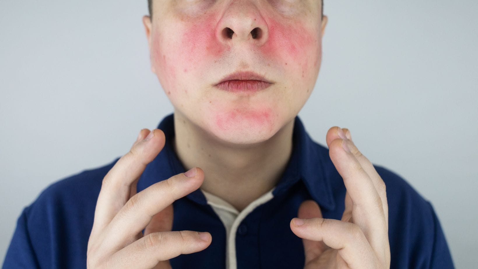 Qu'est-ce que la rosacée et que faire pour régler cela